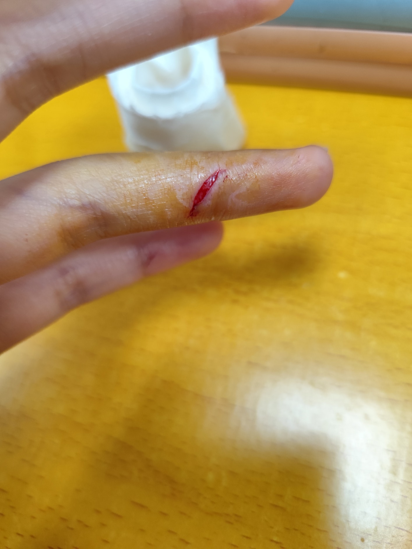 ENHYPEN Community Post - 善禹我受伤了😔